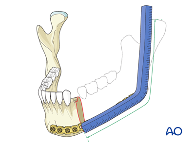 Plate and scapular osteocutaneous free flap for Lateral mandible ...