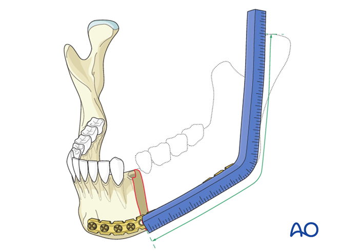 Plate and scapular osteocutaneous free flap for Lateral mandible ...