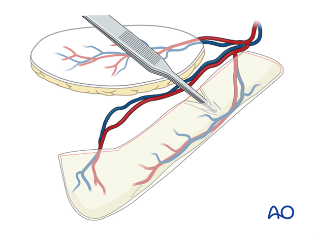 Plate and scapular osteocutaneous free flap for Lateral mandible ...