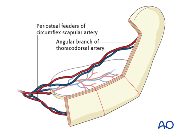 Plate and scapular osteocutaneous free flap for Lateral mandible ...