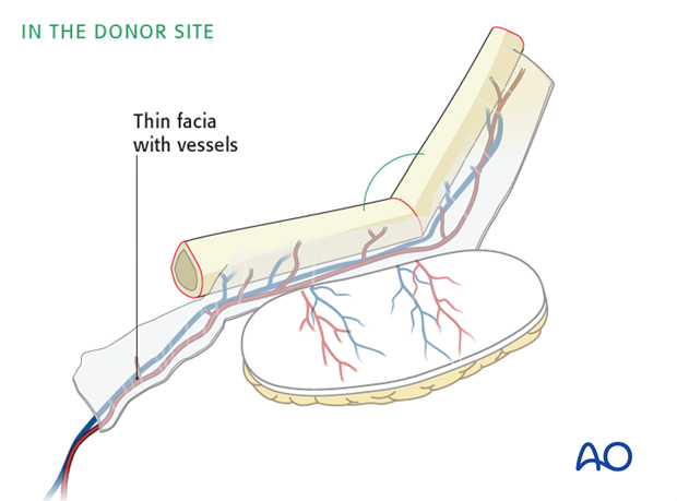 Plate and fibular osteocutaneous free flap for Lateral mandible ...