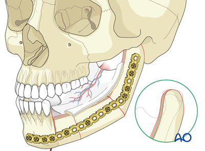 Plate and scapular osteocutaneous free flap for Lateral mandible ...