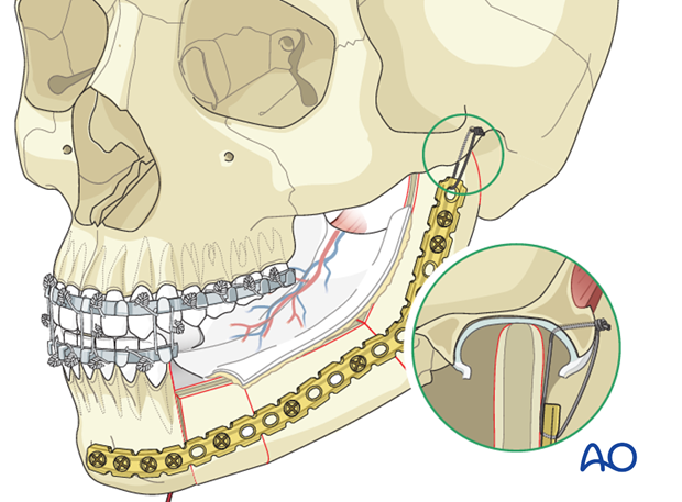 Plate and scapular osteocutaneous free flap for Lateral mandible ...