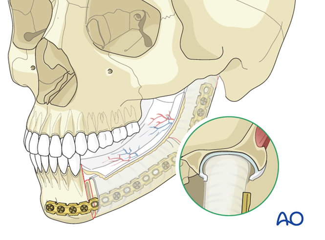Plate and fibular osteocutaneous free flap for Lateral mandible ...