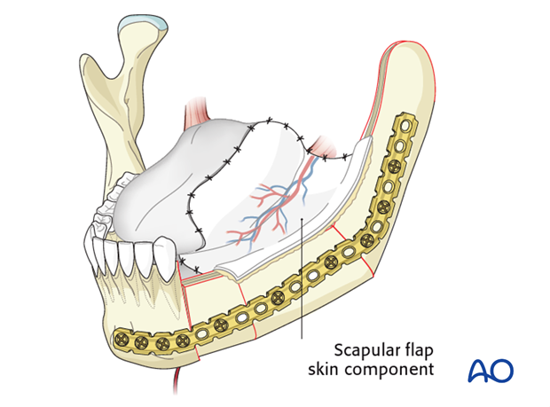 Plate and scapular osteocutaneous free flap for Lateral mandible ...