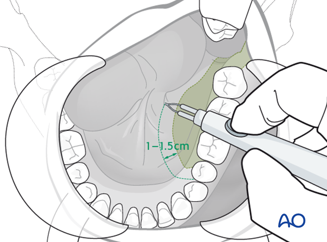 Primary closure for Lateral mandible, condyle, mucosa, with or without ...