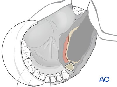 Pectoralis major myocutaneous pedicle flap for Lateral mandible ...