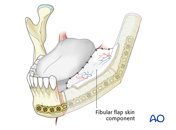 Plate and fibular osteocutaneous free flap for Lateral mandible ...