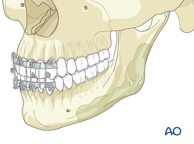 Plate and scapular osteocutaneous free flap for Lateral mandible ...