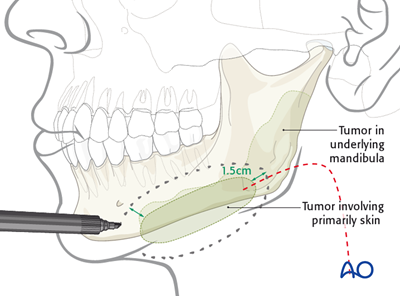 Anterolateral thigh fasciocutaneous free flap for Lateral mandible ...