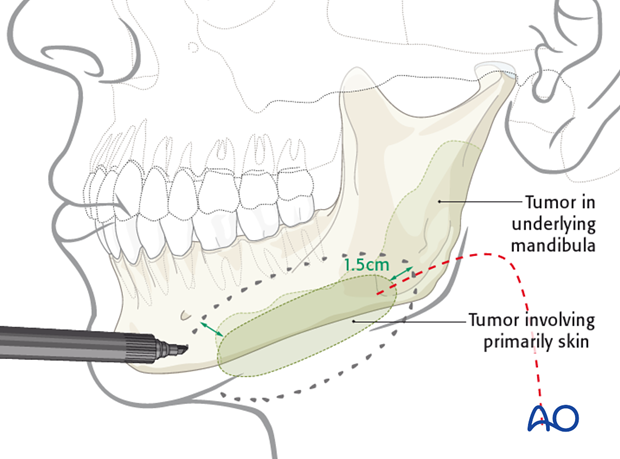 Anterolateral thigh fasciocutaneous free flap for Lateral mandible ...