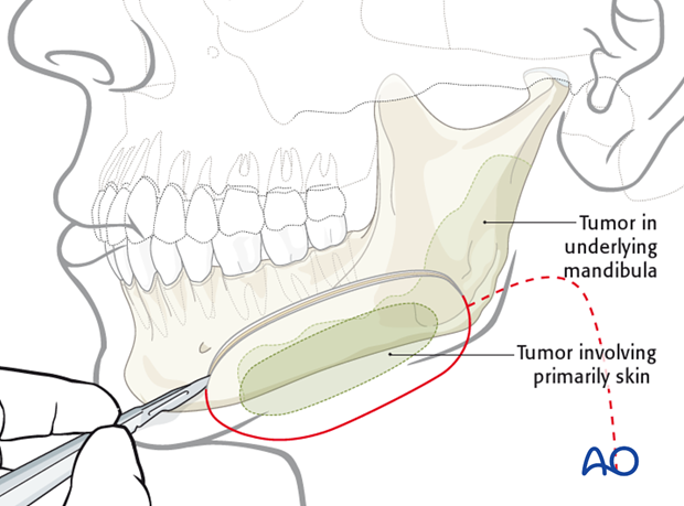 Anterolateral thigh fasciocutaneous free flap for Lateral mandible ...