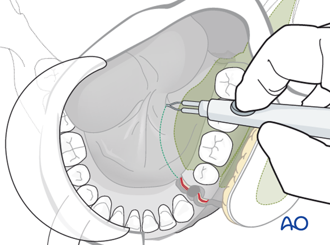 Anterolateral thigh fasciocutaneous free flap for Lateral mandible ...