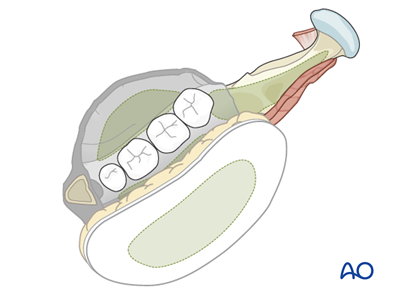 Anterolateral thigh fasciocutaneous free flap for Lateral mandible ...