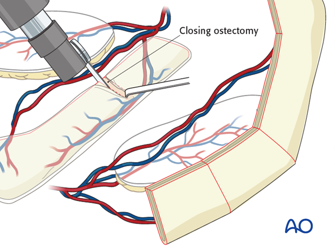 Plate and scapular osteocutaneous free flap for Lateral mandible ...