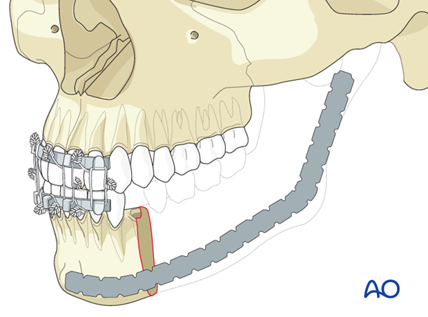 Plate and scapular osteocutaneous free flap for Lateral mandible ...