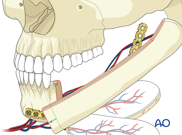 Plate and scapular osteocutaneous free flap for Lateral mandible ...