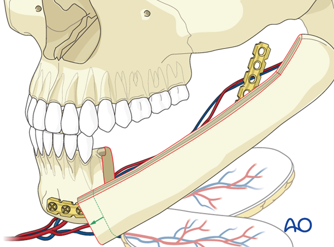 Plate and scapular osteocutaneous free flap for Lateral mandible ...