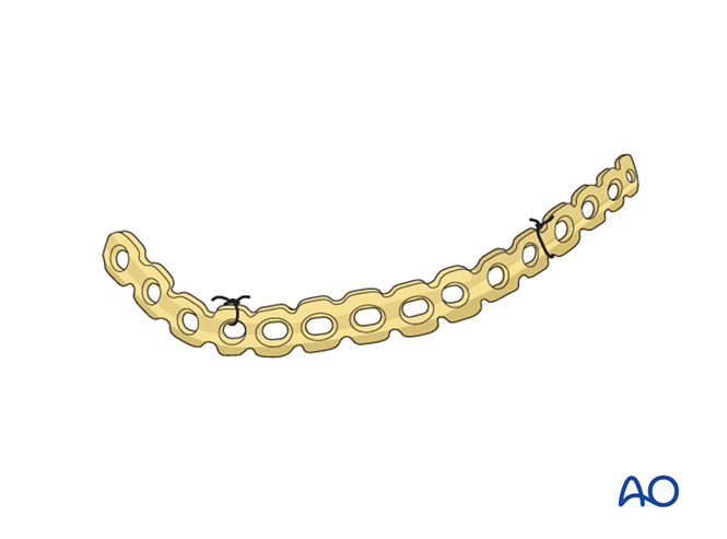Plate and fibular osteocutaneous free flap for Symphysis, mucosa, with ...