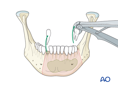 Plate and fibular osteocutaneous free flap for Symphysis, mucosa, with ...