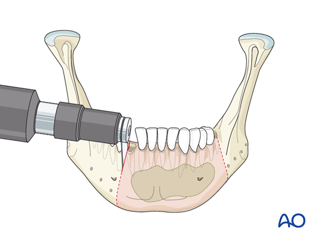 Plate and fibular osteocutaneous free flap for Symphysis, mucosa, with ...