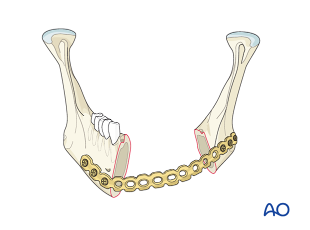 Plate and scapular osteocutaneous free flap for Symphysis, mucosa, with ...