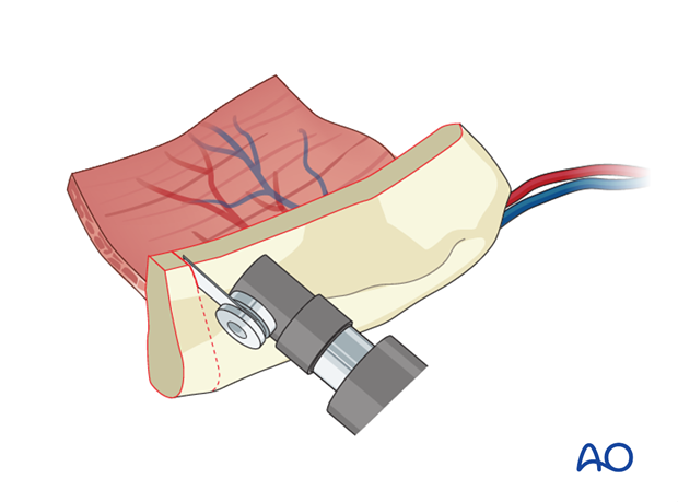 Plate and iliac crest-internal oblique free flap for Symphysis, mucosa ...