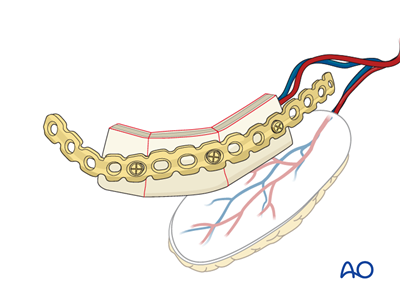Plate and scapular osteocutaneous free flap for Symphysis and skin