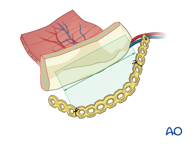 Plate and iliac crest-internal oblique free flap for Symphysis, mucosa ...