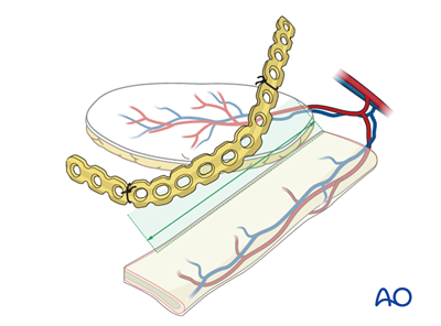 Plate and scapular osteocutaneous free flap for Symphysis, mucosa, with ...