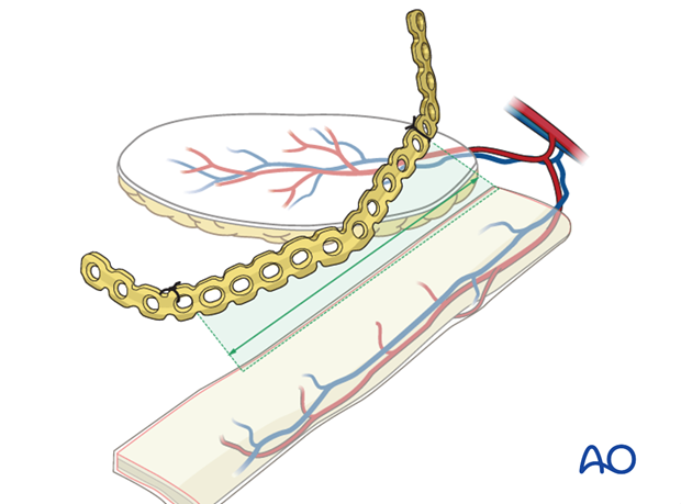Plate and scapular osteocutaneous free flap for Symphysis and skin