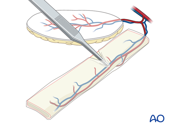 Plate and scapular osteocutaneous free flap for Symphysis and skin