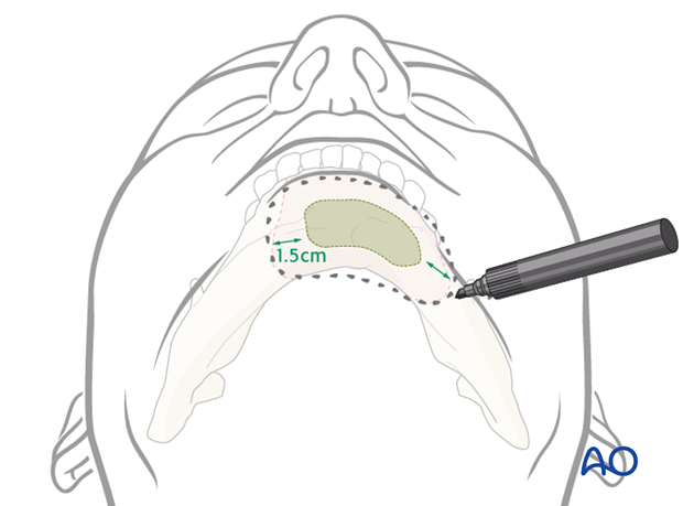 Plate and fibular osteocutaneous free flap for Symphysis and skin