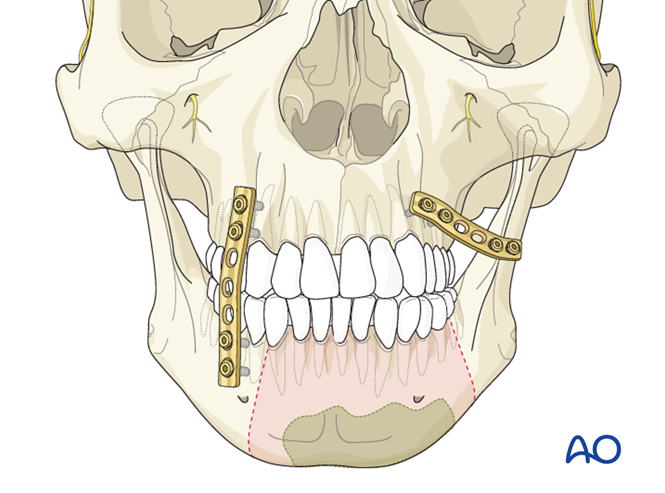 Plate and scapular osteocutaneous free flap for Symphysis, mucosa and skin