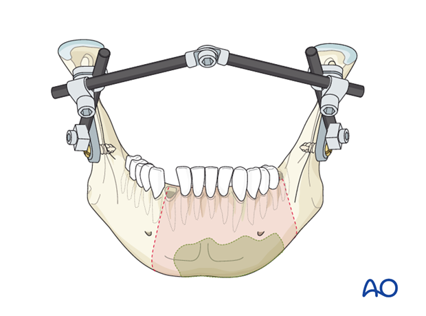 Plate and fibular osteocutaneous free flap for Symphysis and skin