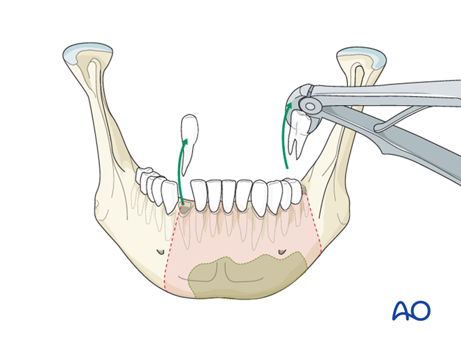 Plate and iliac crest internal oblique free flap for Symphysis, mucosa ...