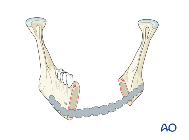 Plate and scapular osteocutaneous free flap for Symphysis, mucosa and skin