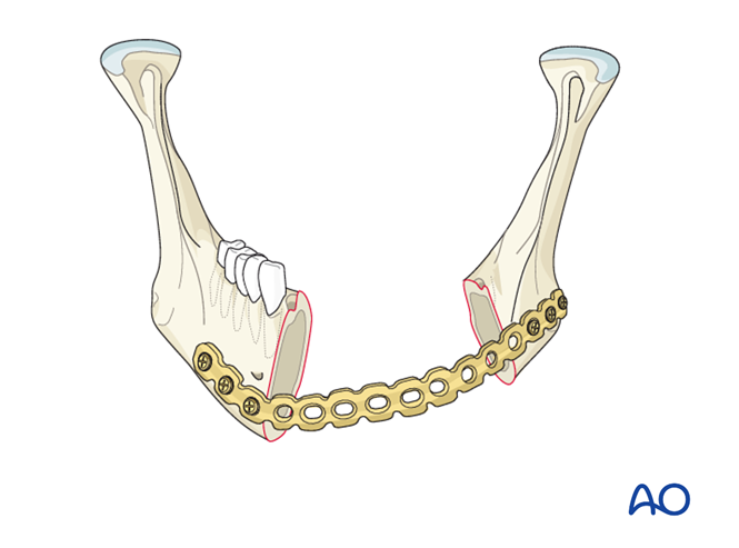 Plate and scapular osteocutaneous free flap for Symphysis, mucosa and skin