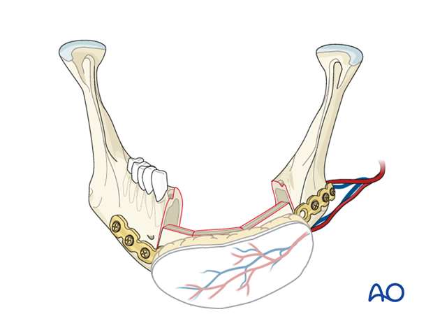 Plate and scapular osteocutaneous free flap for Symphysis and skin