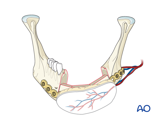 Plate and scapular osteocutaneous free flap for Symphysis and skin