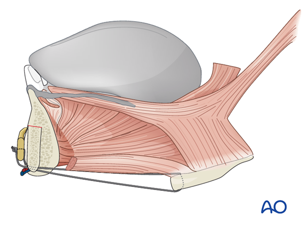 Plate and scapular osteocutaneous free flap for Symphysis and skin