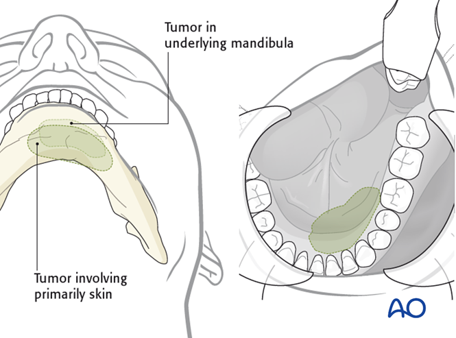Plate and scapular osteocutaneous free flap for Symphysis, mucosa and skin