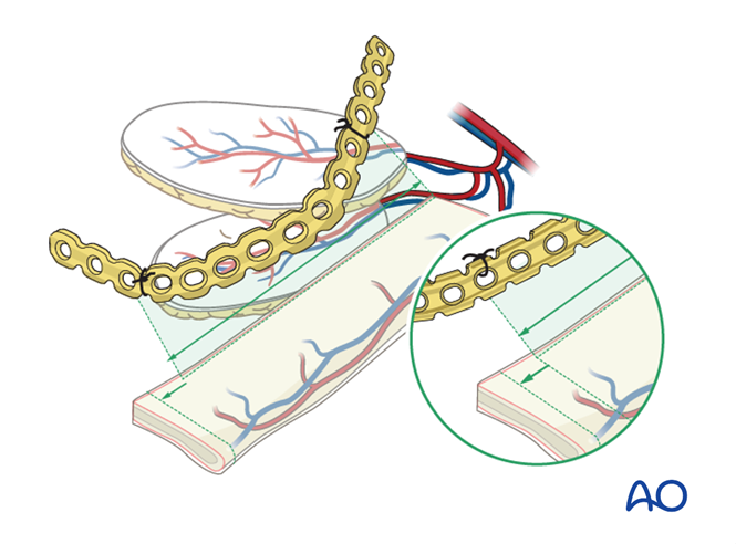 Plate and scapular osteocutaneous free flap for Symphysis, mucosa and skin