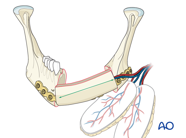 Plate and scapular osteocutaneous free flap for Symphysis, mucosa and skin