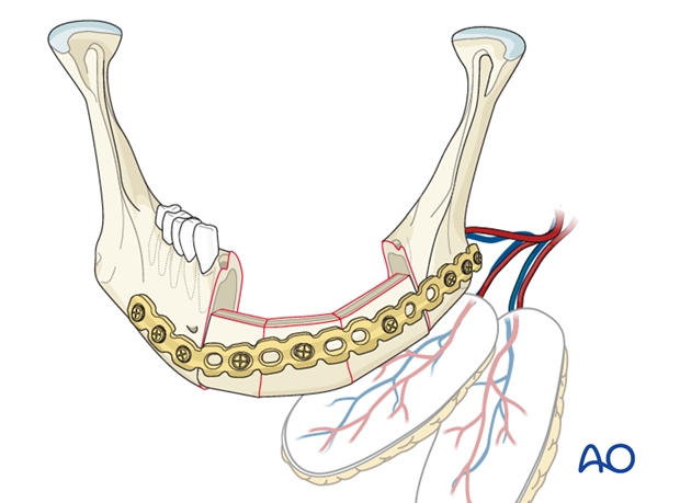 Plate and scapular osteocutaneous free flap for Symphysis, mucosa and skin