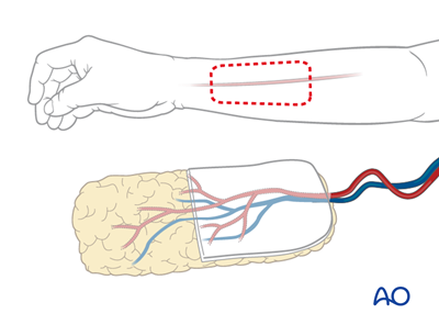 Plate and radial forearm fasciocutaneous free flap for Lateral mandible ...