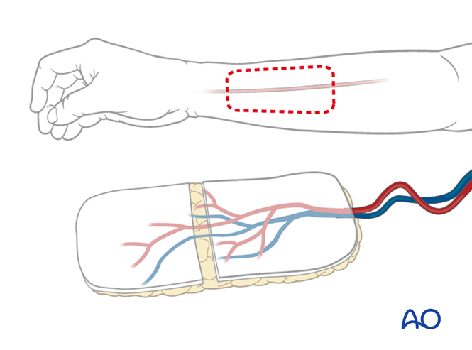 Plate and radial forearm fasciocutaneous free flap for Lateral mandible ...