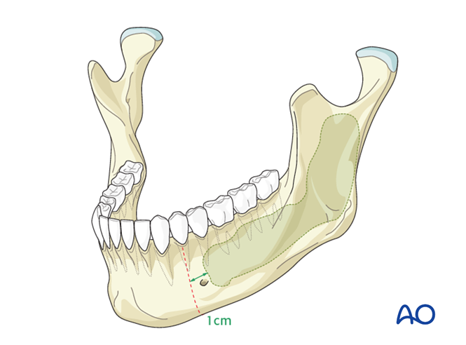 Primary closure for Lateral mandible, condyle, mucosa, with or without ...