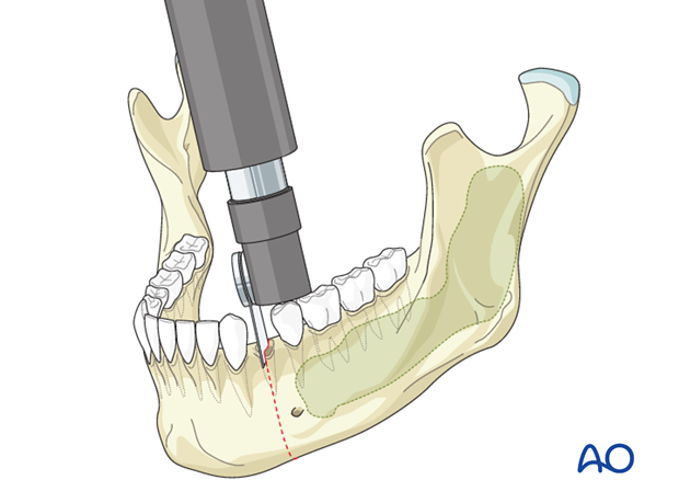 Anterolateral thigh fasciocutaneous free flap for Lateral mandible ...