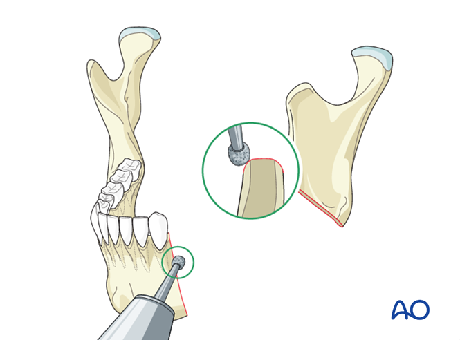 Primary closure for Lateral mandible, mucosa, with or without tongue ...